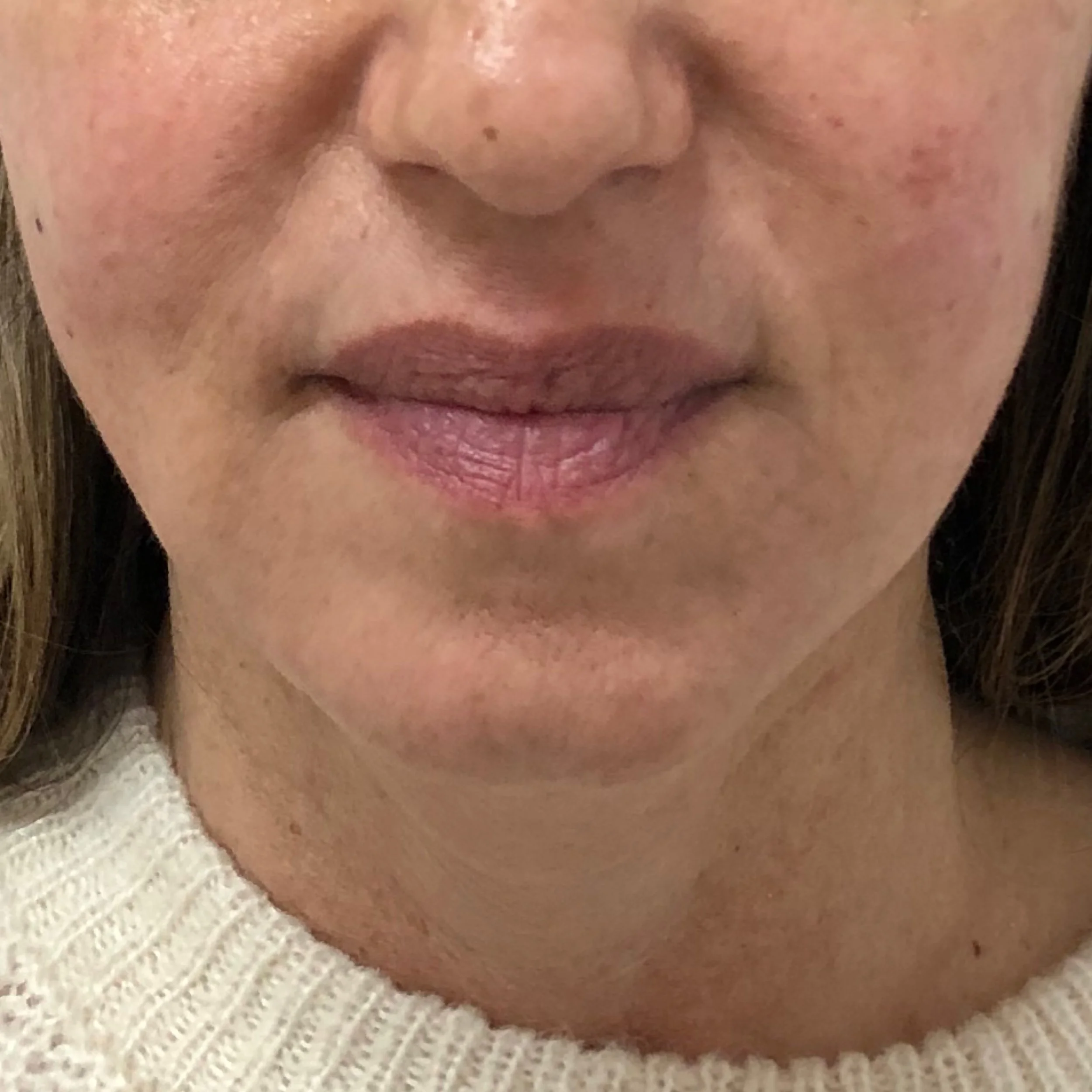 Laughline Fillers Treatment in Redondo Beach, CA — Beauty Cult