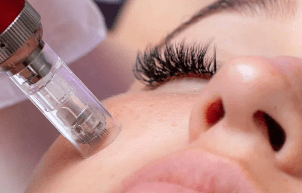 Can Microneedling Help My Acne Scars Disappear? — Clarion Medical ...