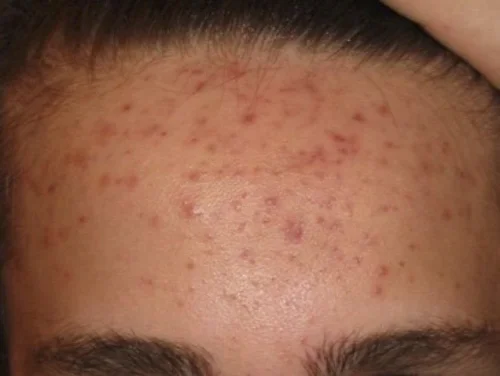 Forehead Acne and Pimples: How To Get Rid Of It? — Clarion Medical ...