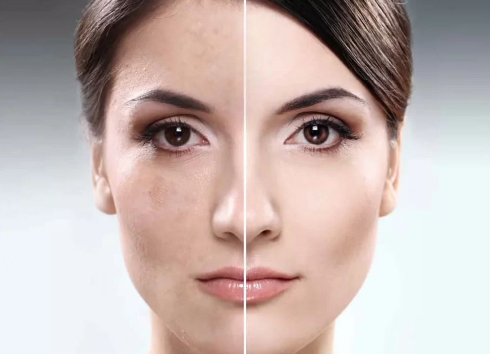 Can Laser Remove Pigmentation Permanently? — Clarion Medical Aesthetic ...