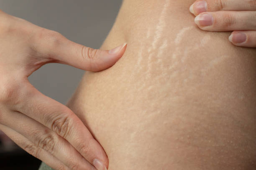 Stretch Marks: Why They Appear & How to Get Rid of Them — Clarion ...