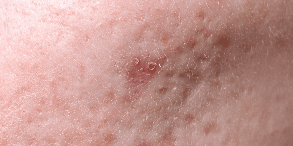 Pitted Acne Scars: How To Get Rid Of It? — Clarion Medical Aesthetic Clinic
