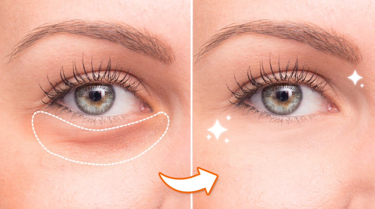 How to Remove Eye Bags: Causes and Effective Solutions — Clarion ...