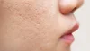 Ice Pick Scars: What Causes & Treatment — Clarion Medical Aesthetic Clinic