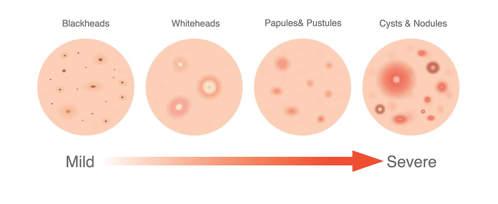 Nodular Acne: Symptoms, Causes & Treatment — Clarion Medical Aesthetic ...