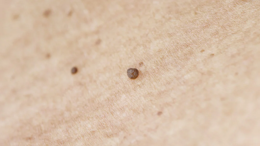 Skin Tags: Causes, Triggers, and Prevention Tips — Clarion Medical ...