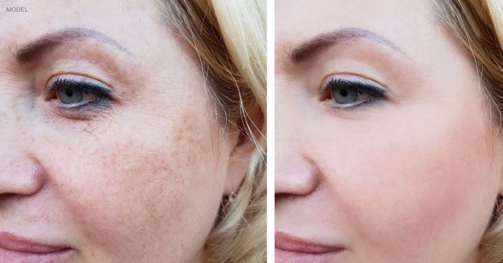 What Is Laser Treatment for Pigmentation Removal? — Clarion Medical ...