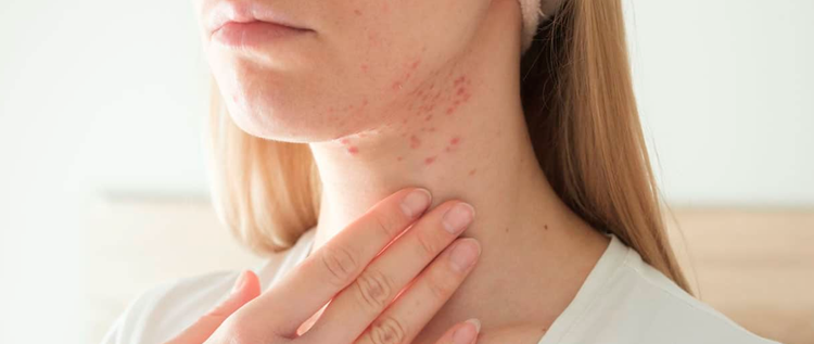 Neck Acne: Causes, Prevention, Treatments You Should Know — Clarion ...
