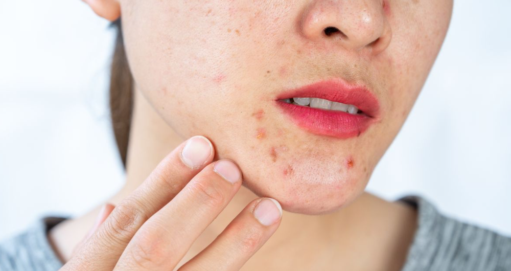How to Get Rid of Acne: Diagnosis and Treatment — Clarion Medical ...