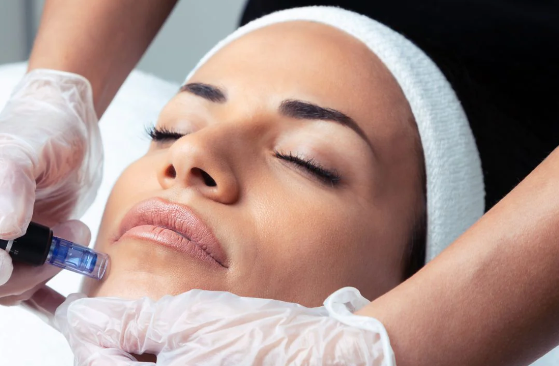 What Is Microneedling: Benefits, Side Effects, Cost, Results — Clarion ...