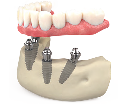 Conelog Progressive-Line BioHorizons Camlog Implant