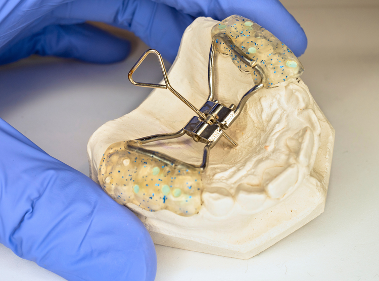 Unlocking Smiles: The Marvels of the Rapid Palatal Expander — Bloom ...