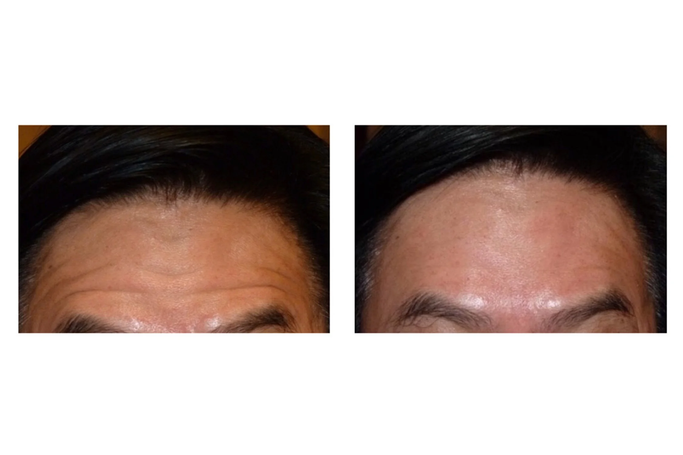 Neurotoxin — Future Bright Dermatology