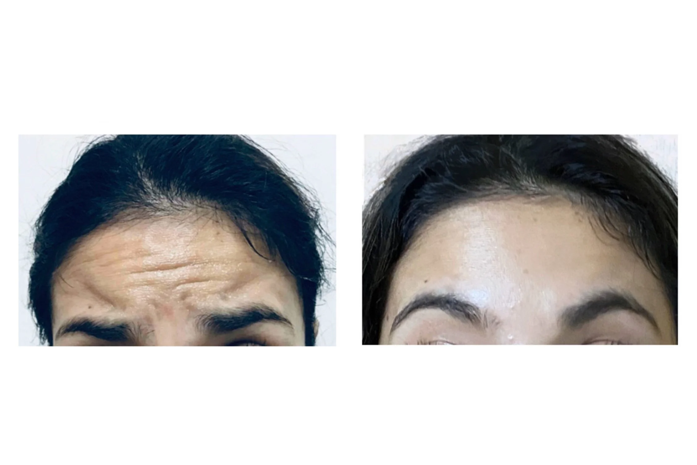 Neurotoxin — Future Bright Dermatology