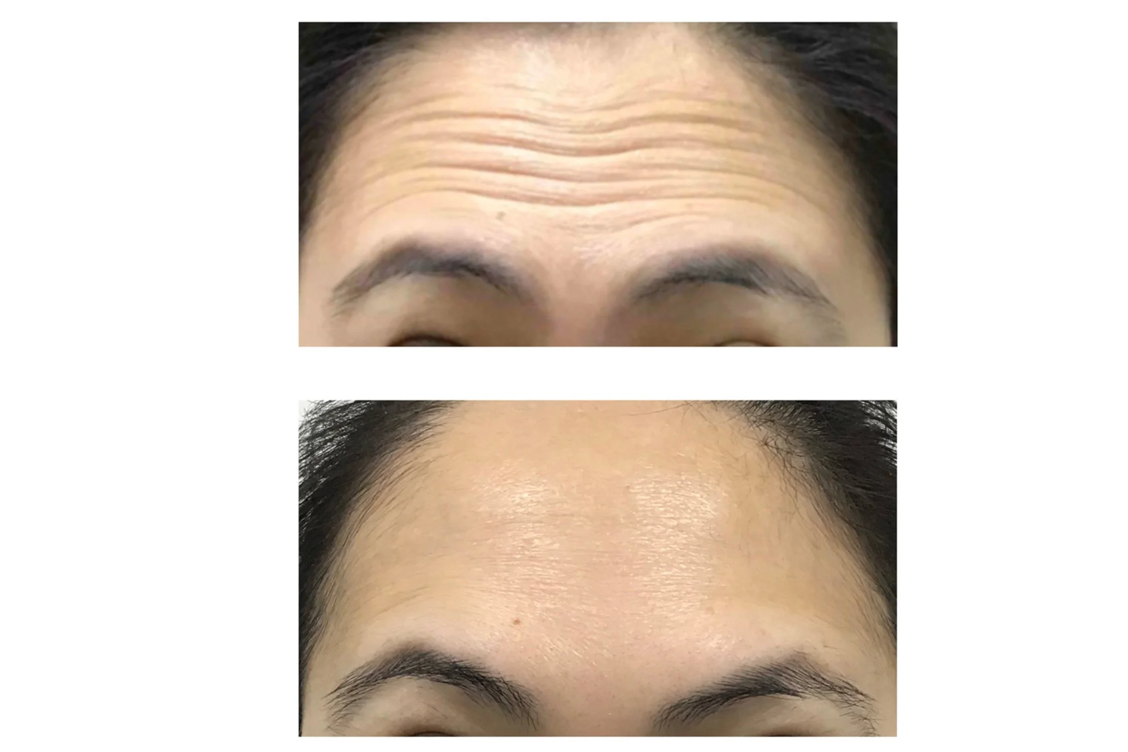 Neurotoxin — Future Bright Dermatology