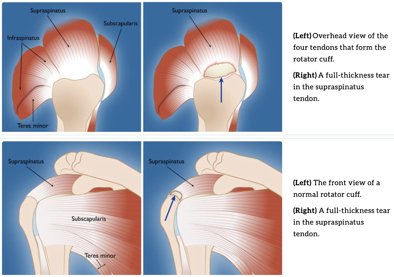 Rotator Cuff Tears — Dr. Ryan E. Harold, Shoulder & Elbow Surgery, Hand ...