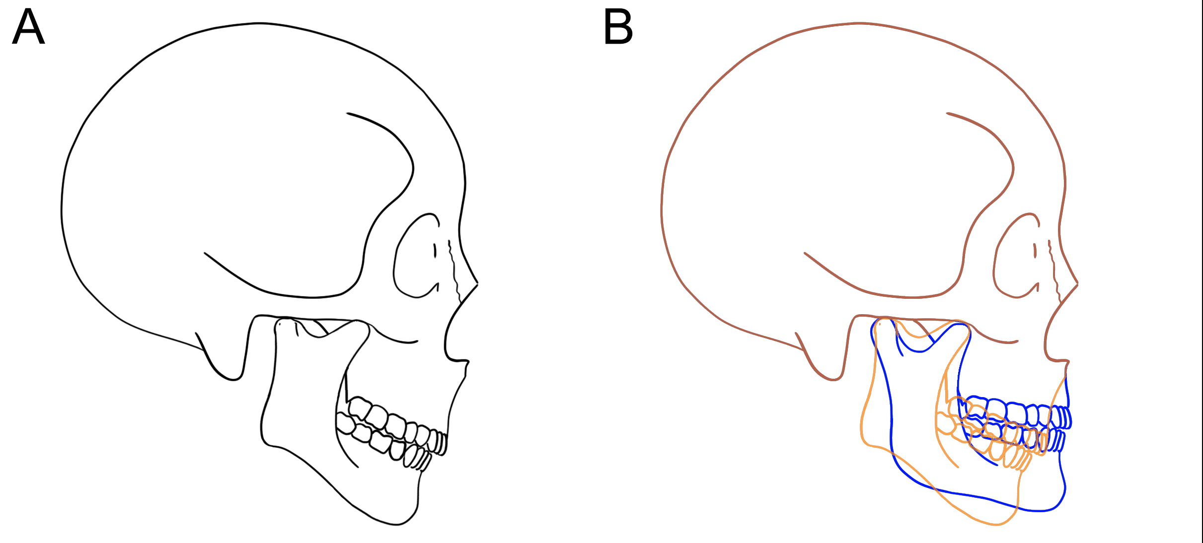 What is Condylar Resorption? — condylarresorption.org