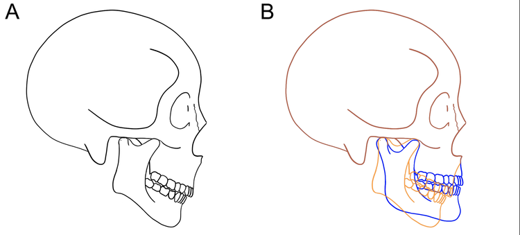 What is Condylar Resorption? — condylarresorption.org