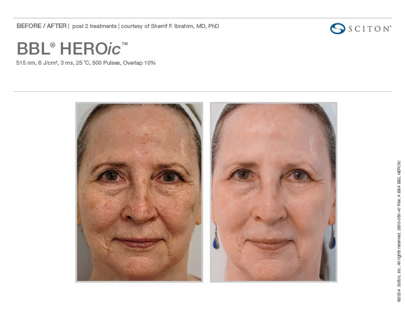 Laser Skincare Treatments Charleston SC — Opal Aesthetics Spa