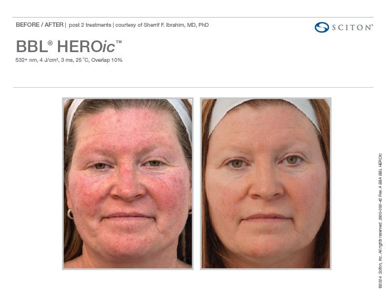 Laser Skincare Treatments Charleston SC — Opal Aesthetics Spa