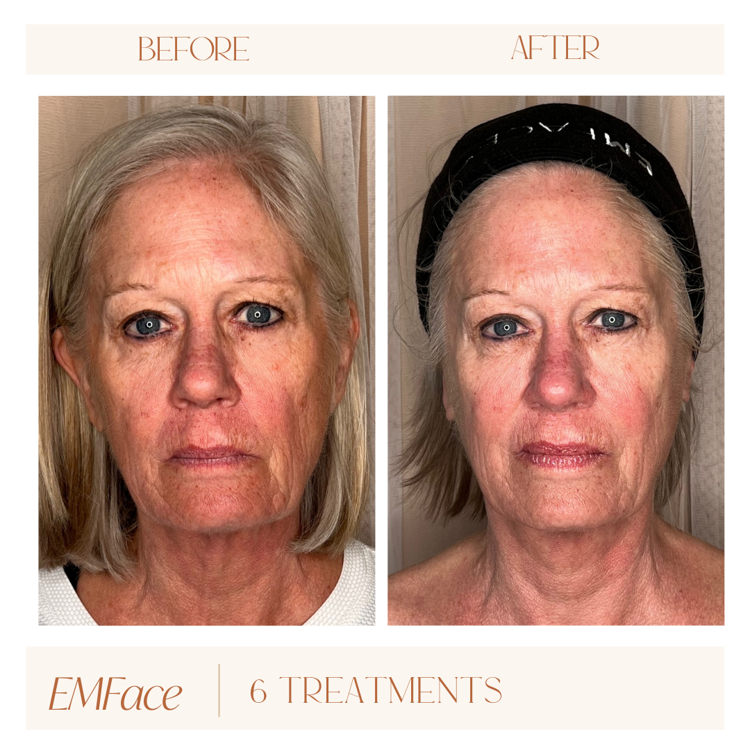 EM Face A Filler Alternative, Meridian — No Filter Aesthetics | Idaho's ...