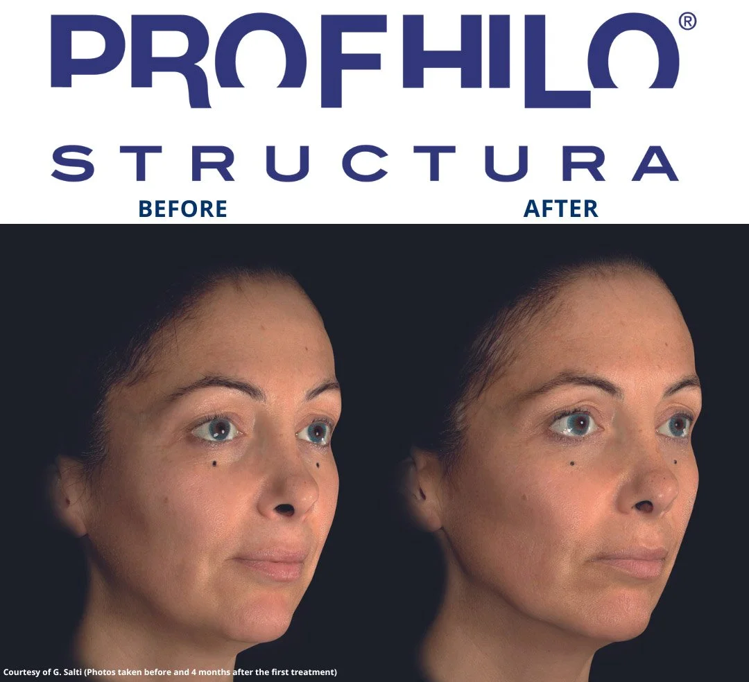Profhilo Structura | SKINLAB Luxury Skin Clinic Deal