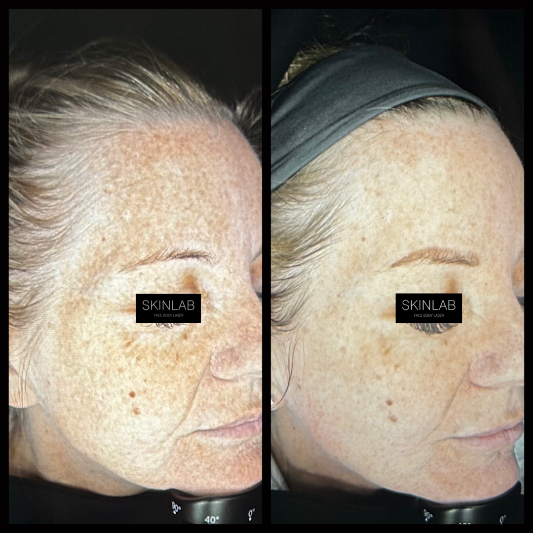March SKINLAB Before & Afters with OBSERV® | SKINLAB Luxury Skin Clinic ...