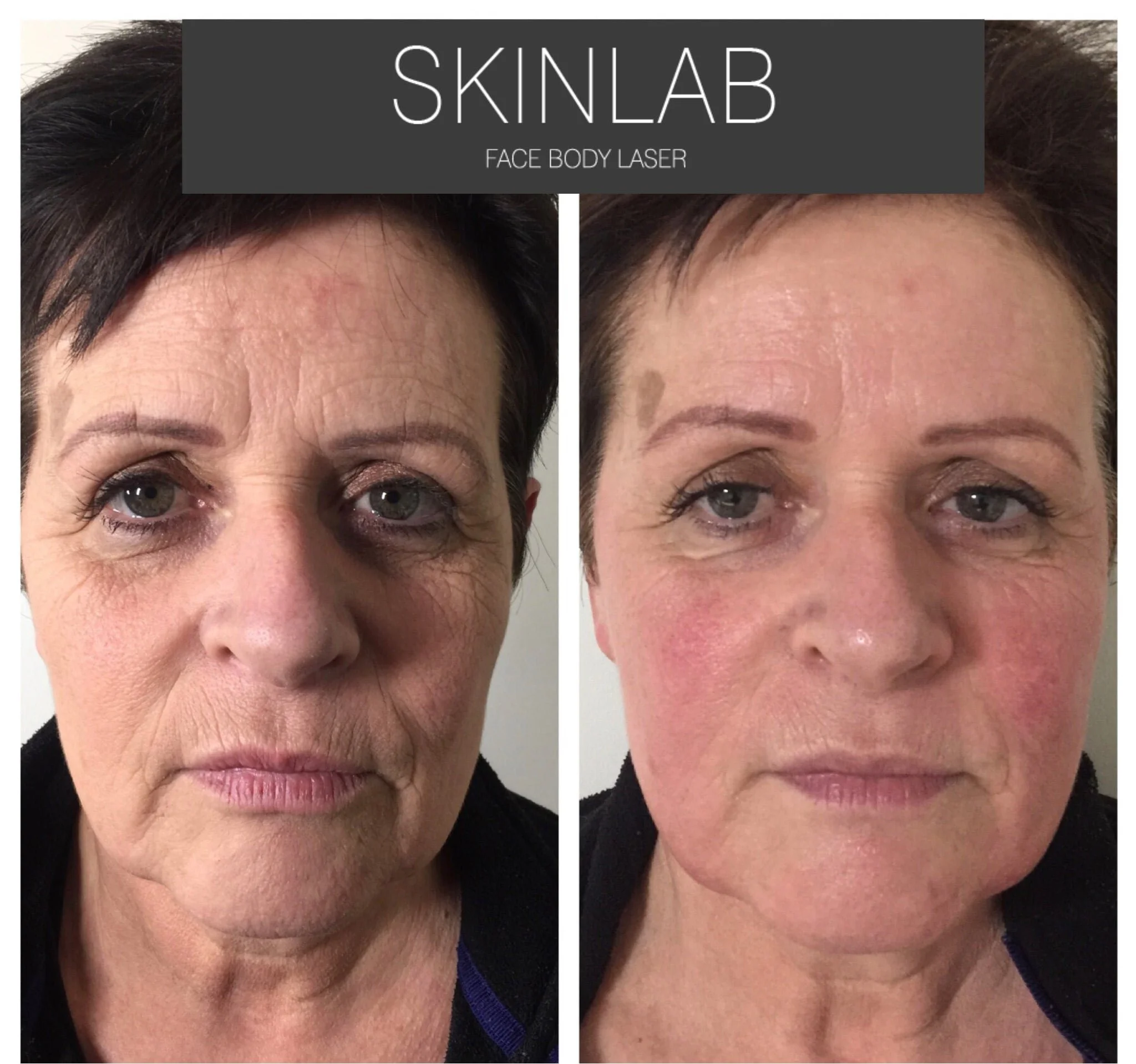 Geneo Facial - The 4 in 1 Super Facial | SKINLAB Clinic Deal