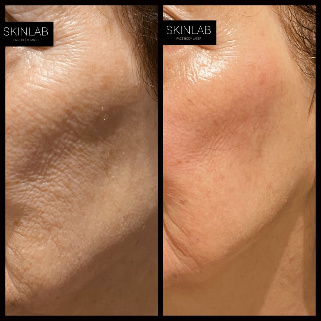 Enhance GENEO results with ultrasound | SKINLAB Clinic Deal