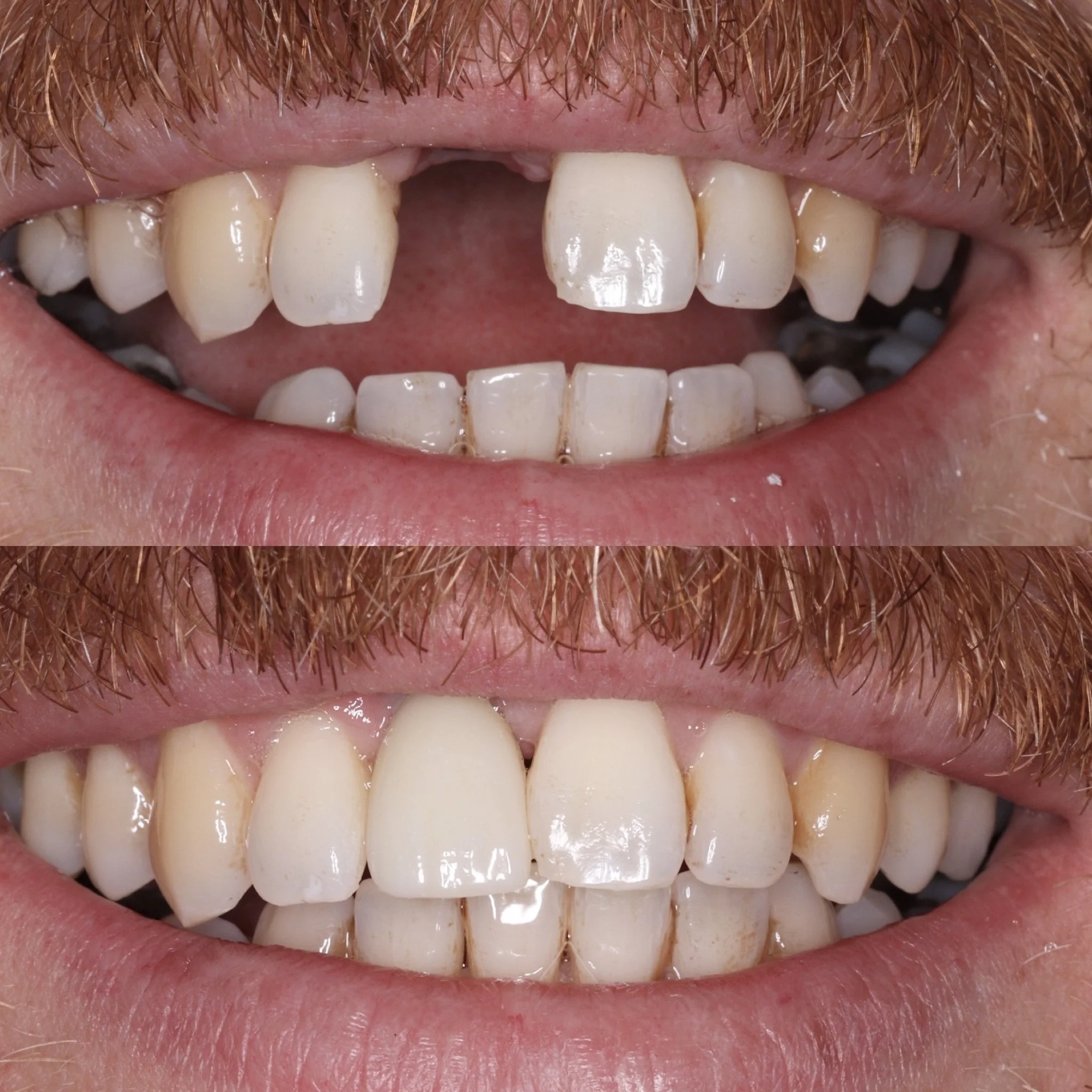 Dental Implants — Denaby Dental Practice