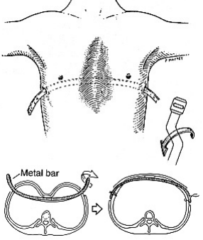 What is the Nuss Procedure? — The Center of Excellence for Pectus