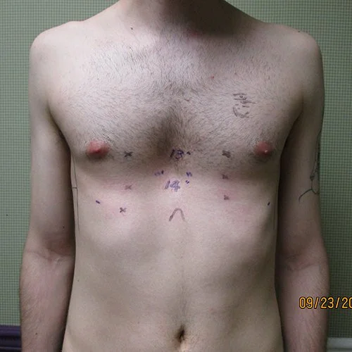 Galleries — The Center of Excellence for Pectus