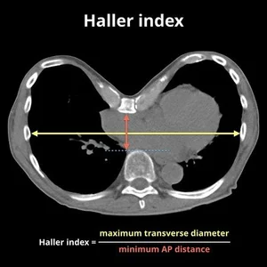 Hallex Index — The Center of Excellence for Pectus