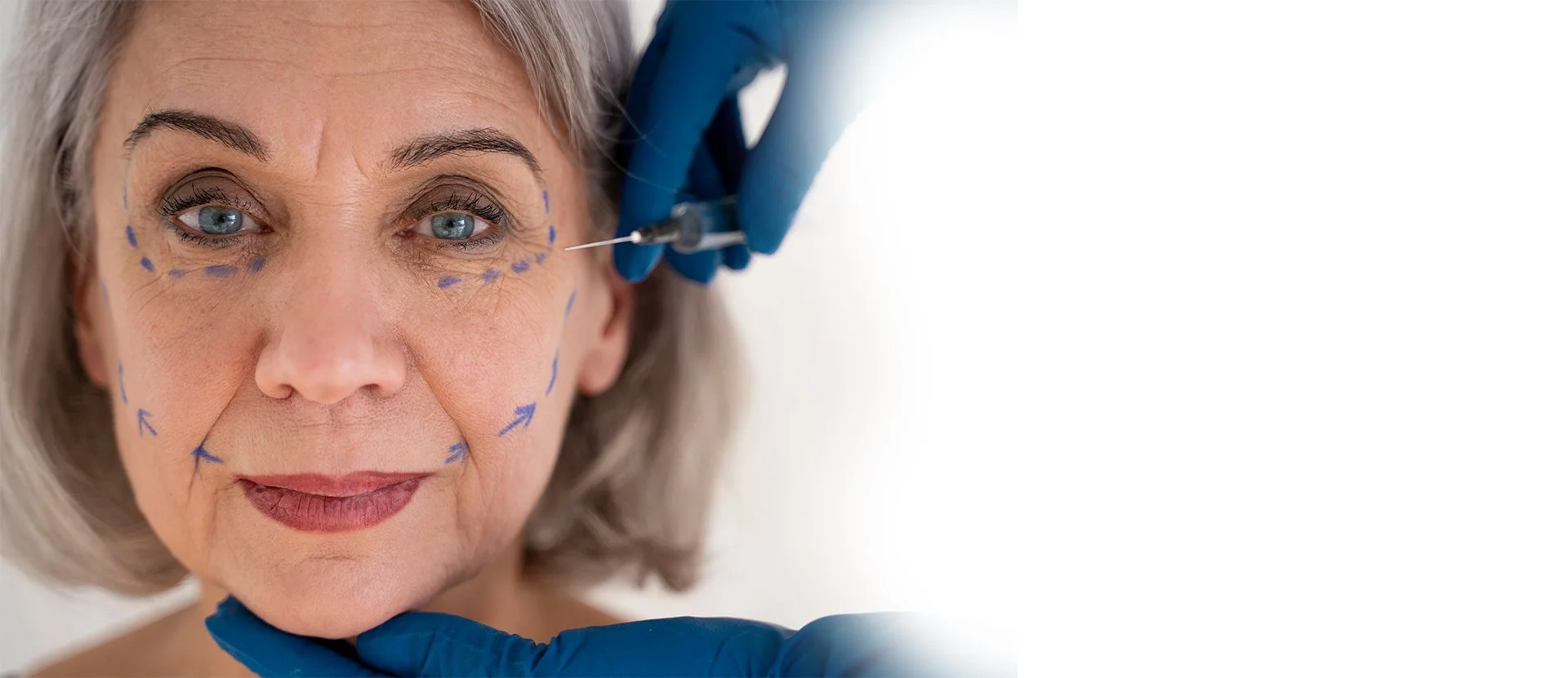 PDO Threads — Beauty Within Med Spa