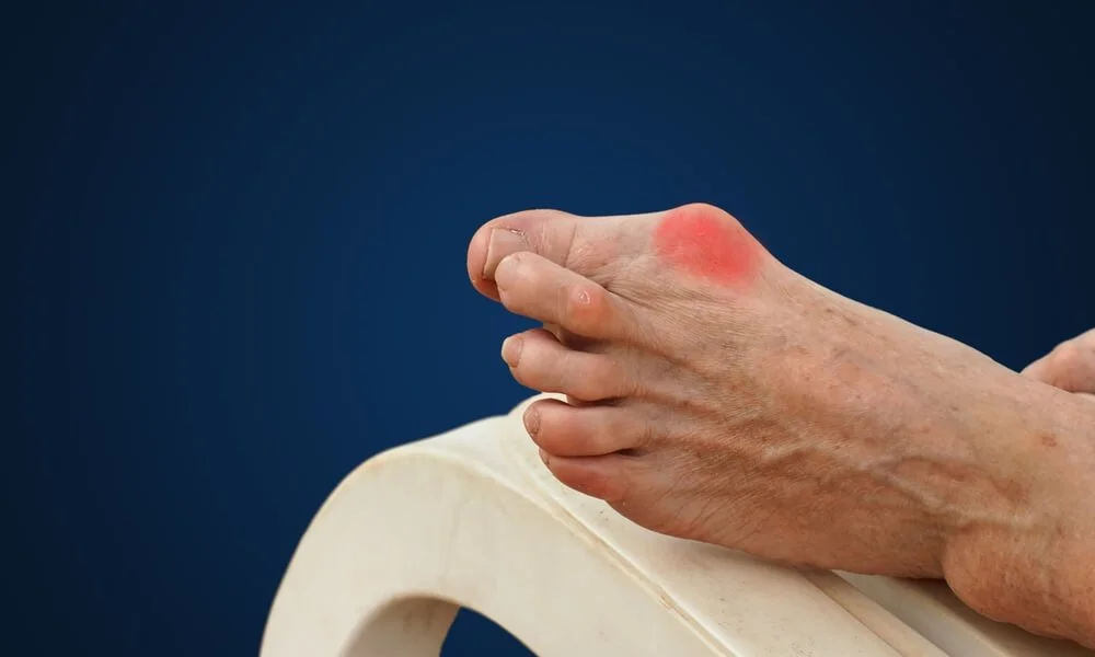Understanding Bunions: Causes, Treatment Options, and How to Prevent ...