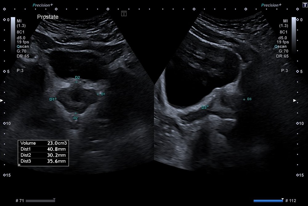 Prostate Cancer Lets Spread Awareness — East Anglia Ultrasound