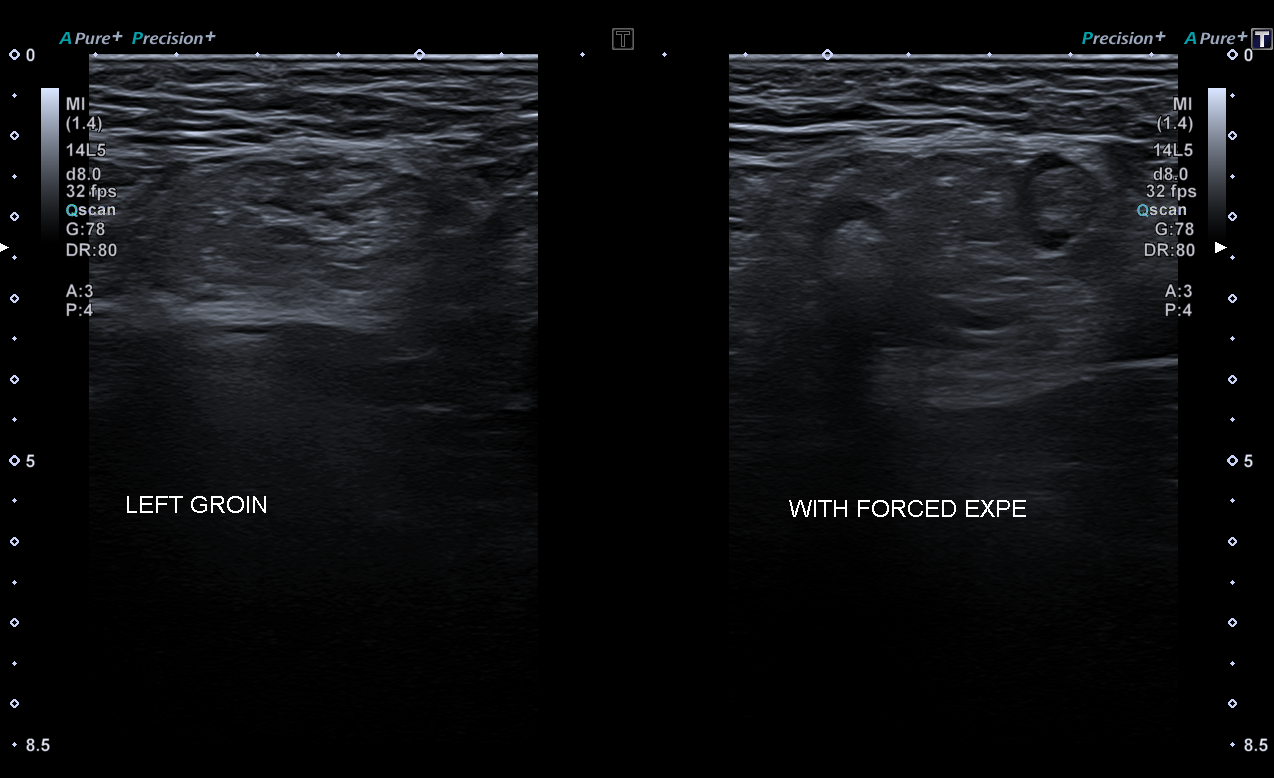 Sports Hernia Ultrasound at Manuel Blount blog