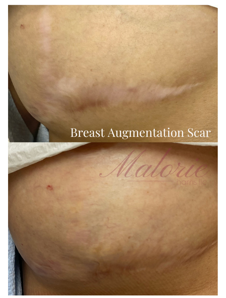 Scar Camouflage — Malorie Harris LLC