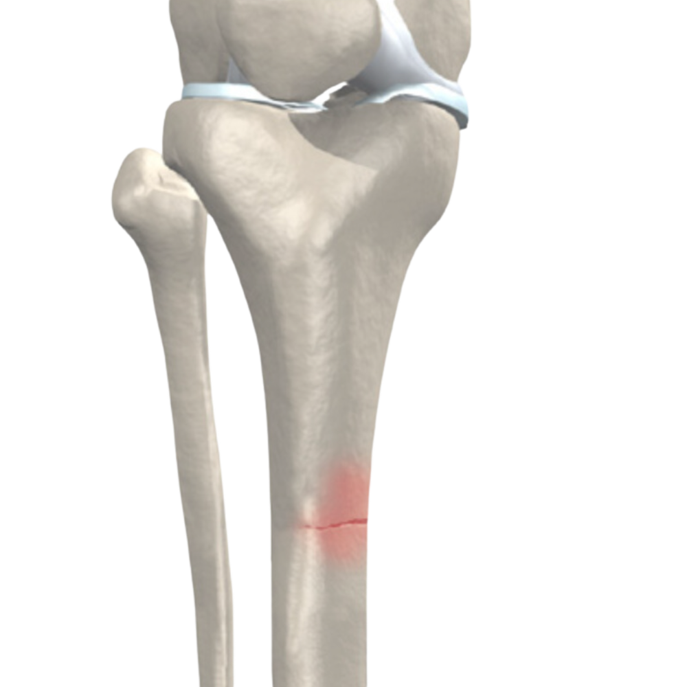 A Complete Guide to Bone Stress Injury in Runners — The Run Rx