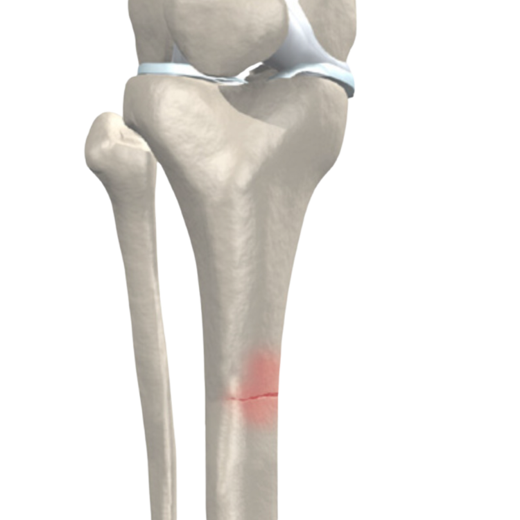 A Complete Guide to Bone Stress Injury in Runners — The Run Rx