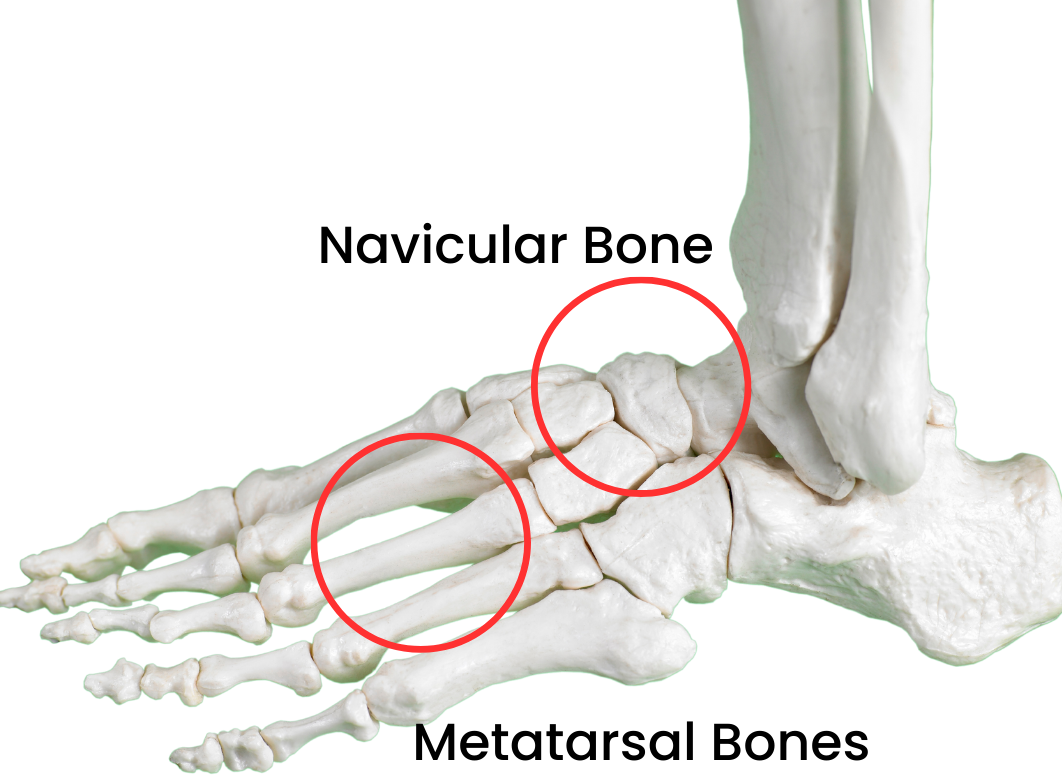 A Complete Guide to Bone Stress Injury in Runners — The Run Rx