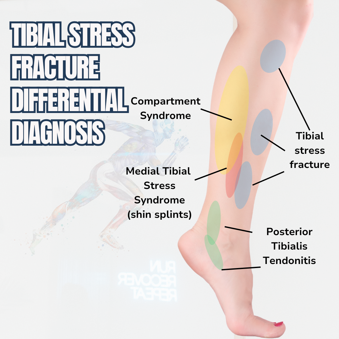 A Complete Guide to Bone Stress Injury in Runners — The Run Rx
