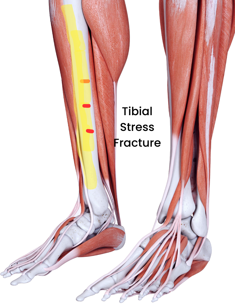 A Complete Guide to Bone Stress Injury in Runners — The Run Rx
