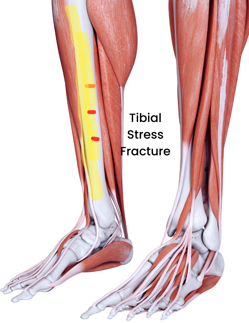 A Complete Guide to Bone Stress Injury in Runners — The Run Rx