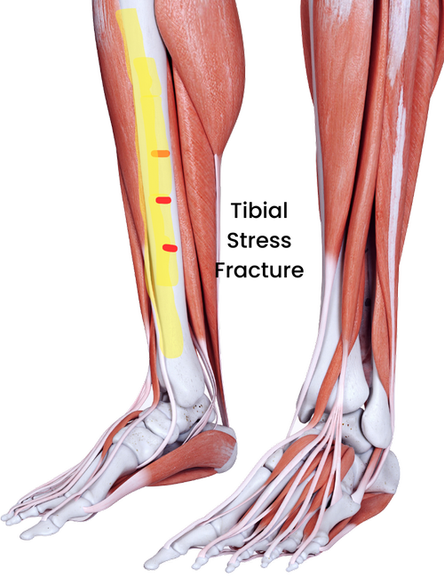A Complete Guide to Bone Stress Injury in Runners — The Run Rx