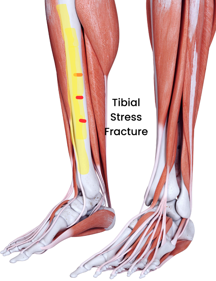 A Complete Guide to Bone Stress Injury in Runners — The Run Rx