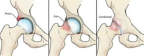 Hip Impingement + Labral Tears in Runners | The Run Rx Physical Therapy ...