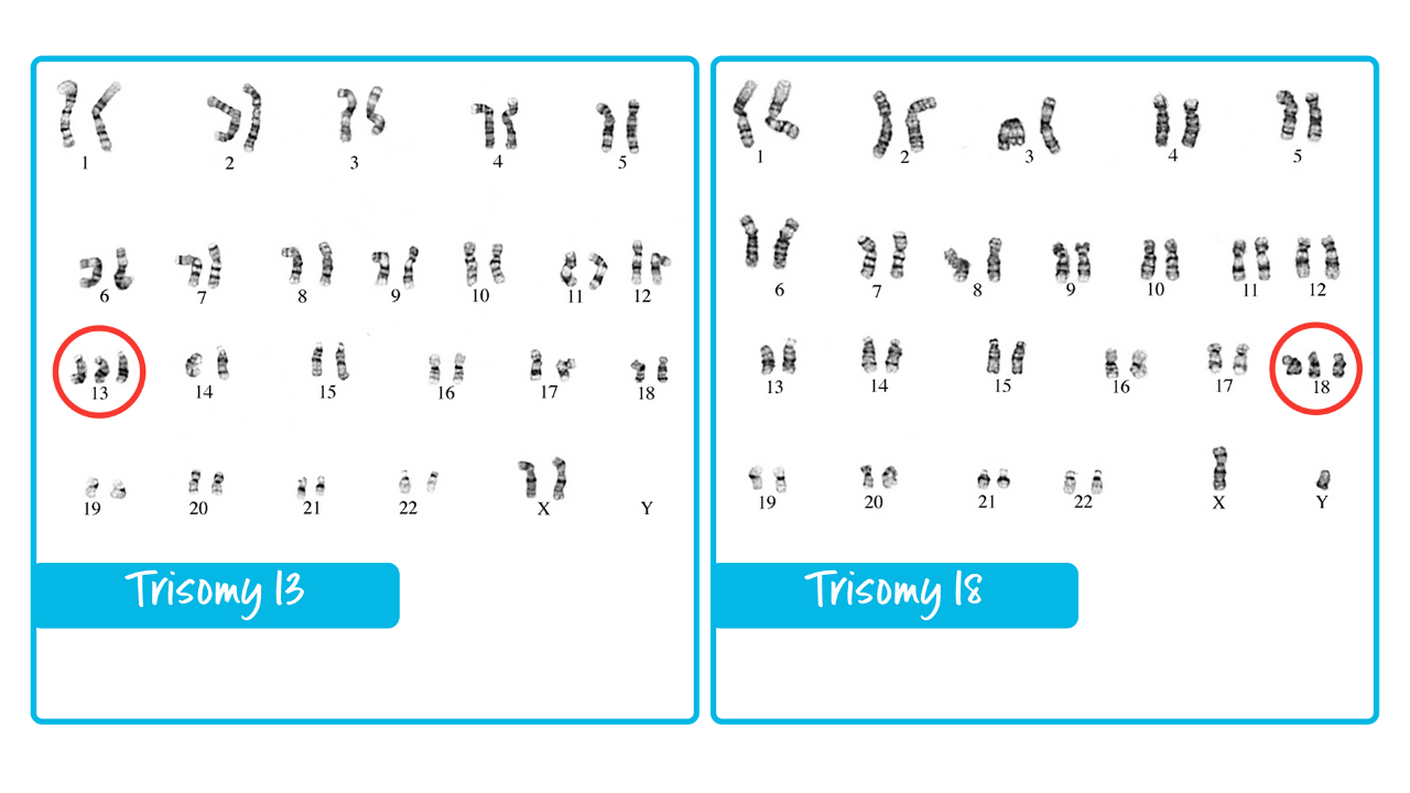 SOFT UK | Support Trisomy Awareness Today