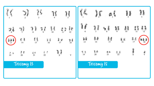SOFT UK | Support Trisomy Awareness Today