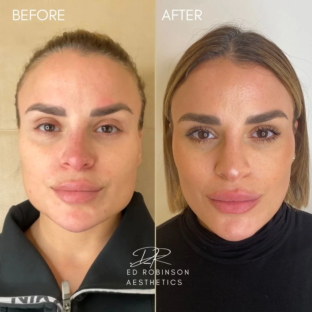 Injectable Stress Relief: Masseter Botox — Dr Ed Robinson Aesthetics